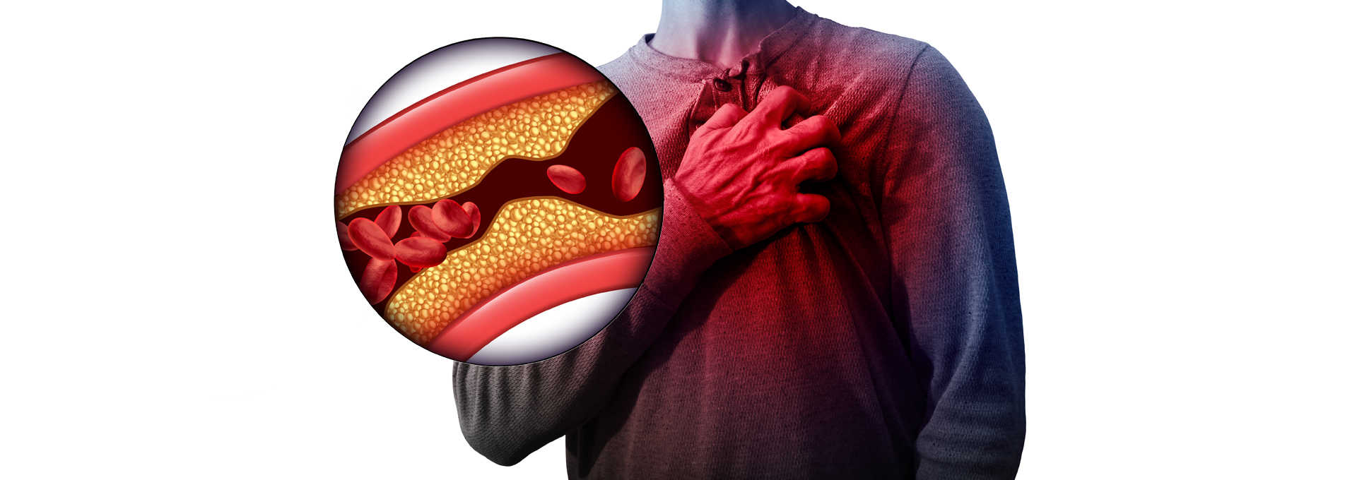 Kardiovaskularne bolesti: Koronarna bolest srca